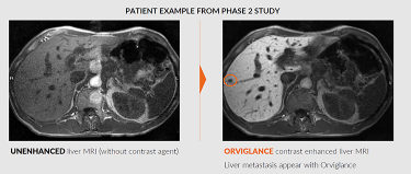 Setting a new standard of care for liver MRI contrast agents