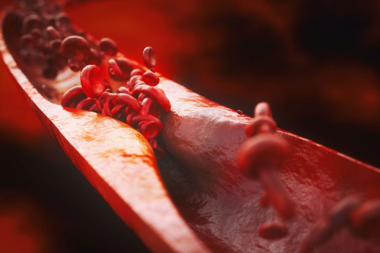 Noninvasive therapy may reverse atherosclerosis - EPR