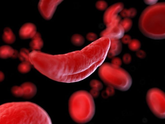 Sickle Cell Society - News, Articles etc. - European Pharmaceutical Review