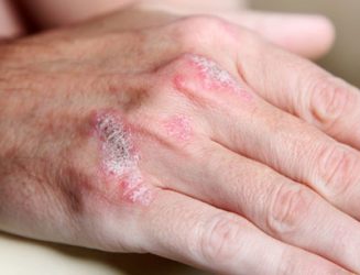 Cosentyx superior in sustained skin clearance in psoriasis